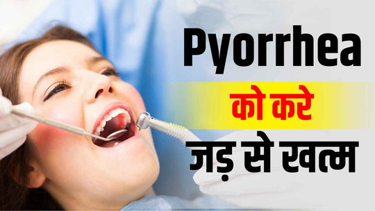 पायरिया (Pyorrhea) को करे जड़ से खत्म – Rambaan Aushadhi